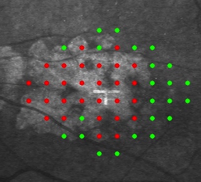 Micro-Perimetry by Scanning Laser Ophthalmoscope | Smith-Kettlewell Eye ...